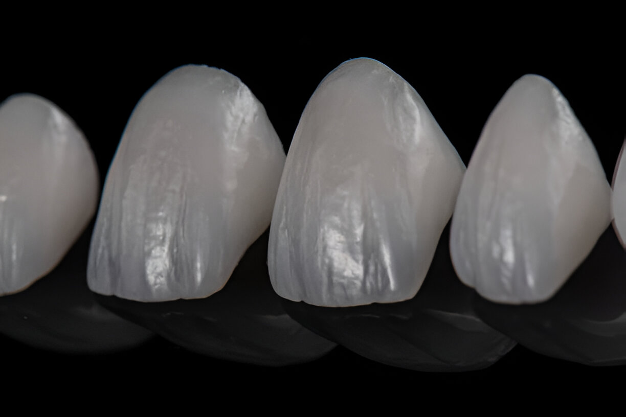 Can Veneers Be Done in One Day?
