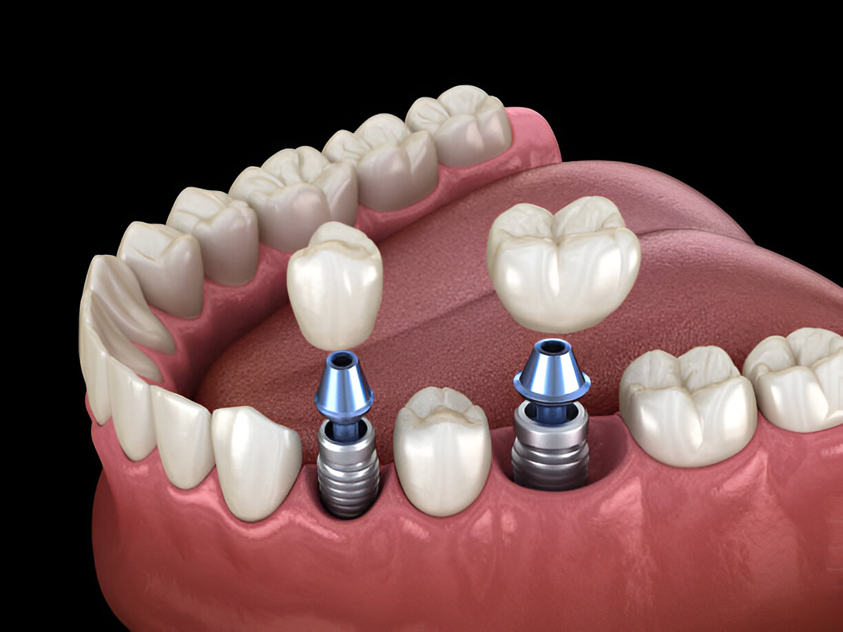 Can a Dental Implant Be Done in One Day?